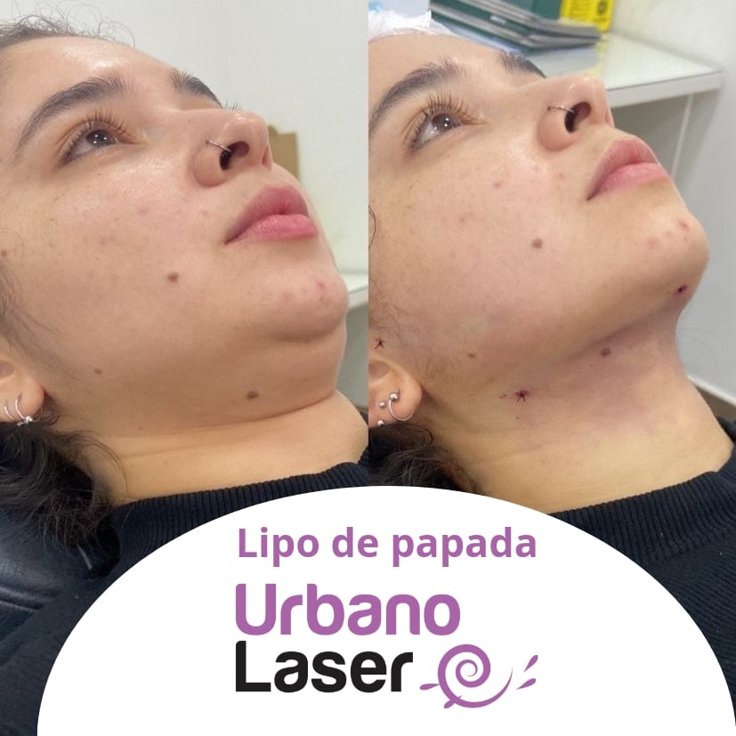Lipo de Papada - Urbano Laser
