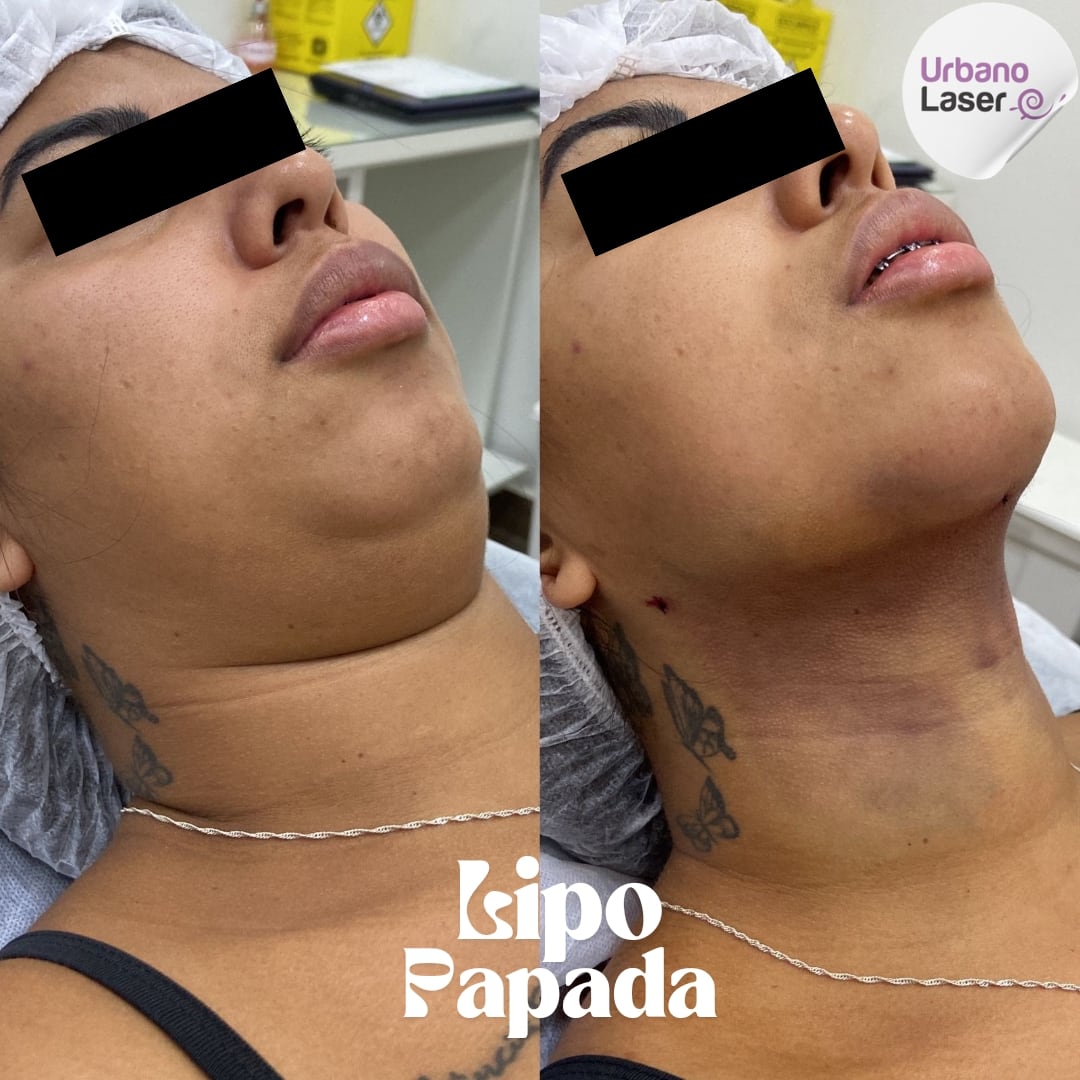 Lipo de Papada - Urbano Laser